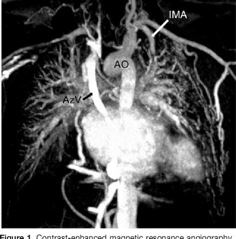 Lymph Node Of Aortopulmonary Window Semantic Scholar