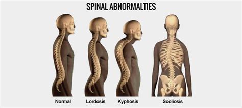 Lordosis And Swayback Care In Kl Spinal Curve Management
