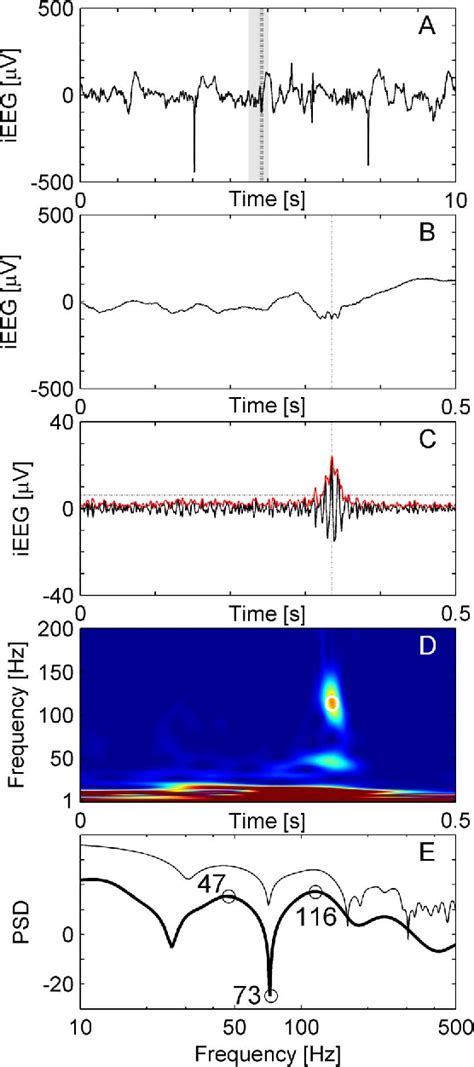 Figure 1 From Human Intracranial High Frequency Oscillations Hfos