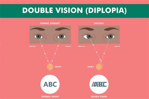 Managing Double Vision Diplopia A Guide For Indians