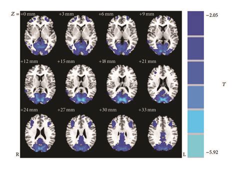 Regions Showing Significant Differences In Voxel Mirrored Homotopic Download Scientific Diagram