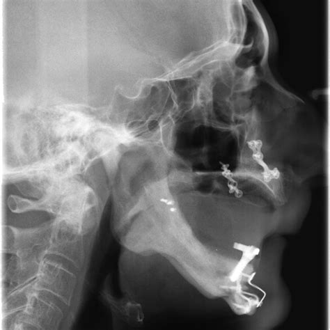 Preoperative Lateral Cephalogram From A Retrognathic Patient With