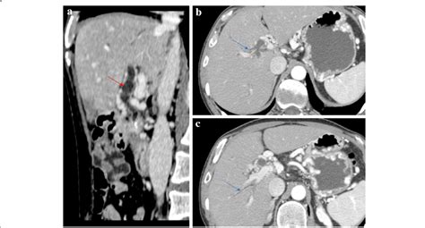 Portal Biliopathy Sagittal Portal Venous Phase Ct Images Shows