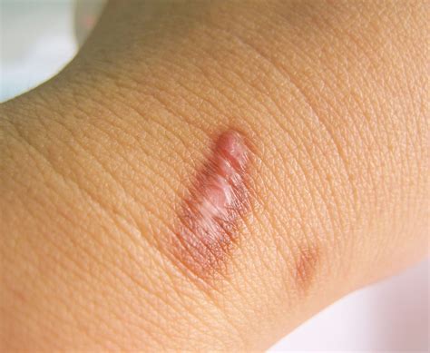 Can You Stop Keloids From Growing Live Enhanced