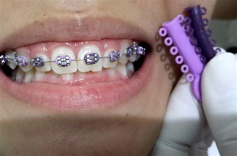 Pin By Sara Kassab Fiorill On Braces Colors In 2024 Braces Colors Dental Braces Colors
