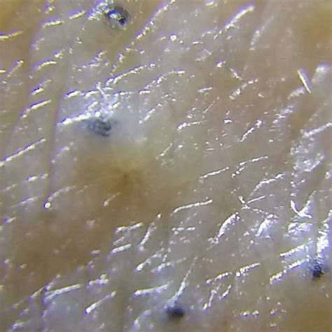 毛穴 角栓 Oilyskin Blackhead Youtube