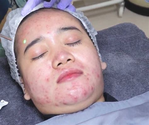 Acnescars Dr Belle Aesthetic Clinic