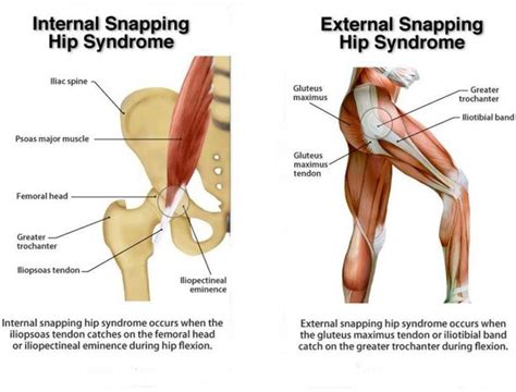Snapping Hip Syndrome