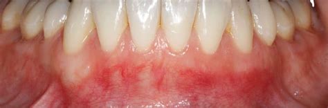 Soft Tissue Graft Alternatives For Treating Mucogingival Defects