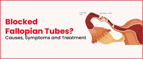 Blocked Fallopian Tubes Causes Symptoms And Treatment
