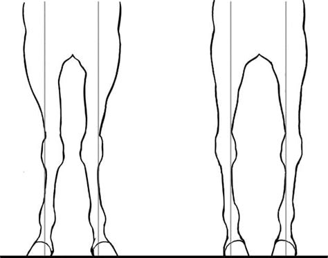 Whoazone 🩻 Straight From The Start Understanding Angular Limb