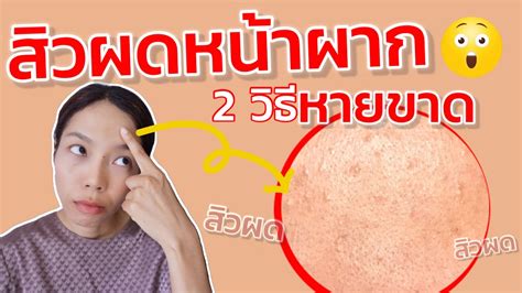2วิธีรักษา สิวผดที่หน้าผาก สิวผดเกิดจากอะไร สิวผด รักษายังไง สิวผดหายใน