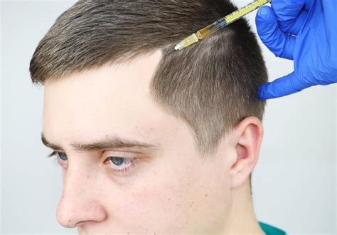 Prezzo Di Un Trapianto Di Capelli Senza Rasatura In Tunisia