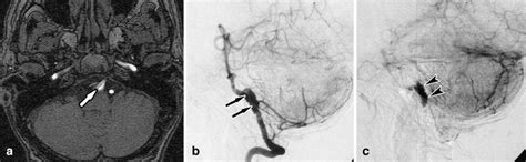 Dissection Of The V4 Segment Of The Vertebral Artery Clinicoradiologic