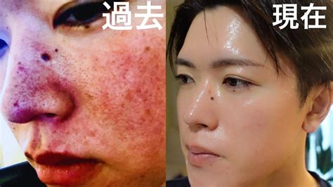 【スキンケア 肌荒れ】着実に肌をキレイにしていく男の日常 Youtube