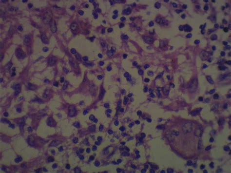 Pathology Outlines Salmonella