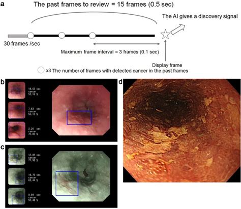 Revolutionary Cancer Detection Enzymatic Sequencing And Ai Boost Escc