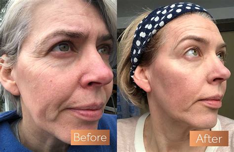 Collagen Powder Benefits Before And After At Elvira Pierce Blog