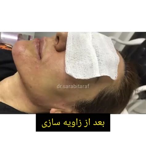 فیلم زاویه سازی فک