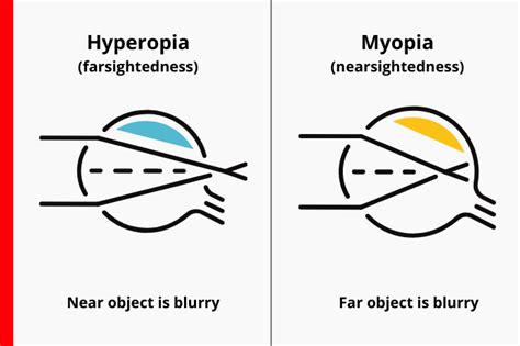 Nearsighted Vs Farsighted Vision Gunnar