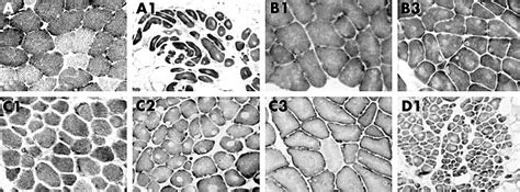 Central Core Disease Clinical Pathological And Genetic Features