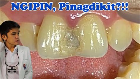 Medical Term Of Pasta Ng Ngipin In English At Betty Sansbury Blog