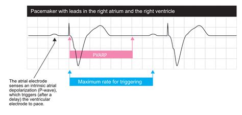 Basic Cardiac Pacing Pacemaker Functions And Settings