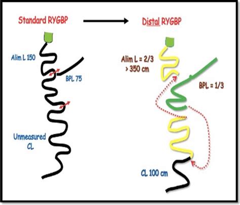 Rygbp Distalization Technique Alim L Alimentary Limb Bpl