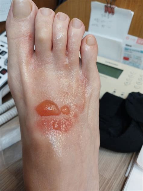 파스 호랑이연고 붙이고 잤더니 물집같이 지식in