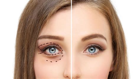 Blefaroplastia descubra tudo sobre a cirurgia das pálpebras