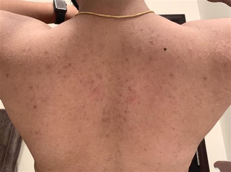 Acne Scars On Back Before And After Effective Non Surgical Methods For