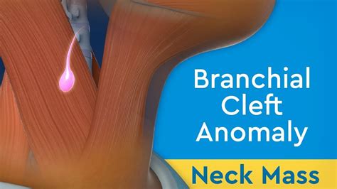 Branchial Cleft Cyst Youtube