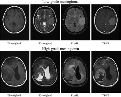 Differentiation Of Low And High‐grade Meningiomas Using Transfer