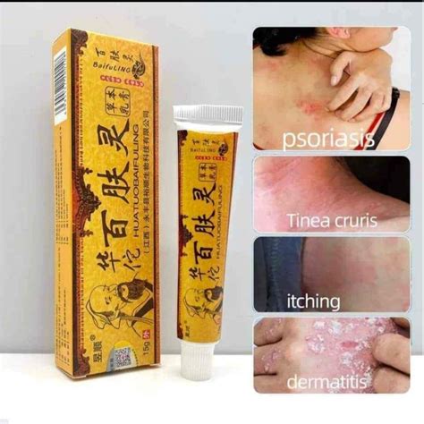Gatal Ringworm Gatal Psoriasis Eczema Ringworm Kudis
