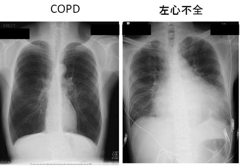 喘鳴 ピクトグラムでわかる呼吸器内科