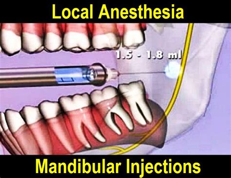 Florida Dental Anesthesia Rules At Jared White Blog