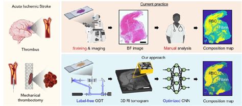 Proposed Thrombus Composition Prediction Compared To The Current