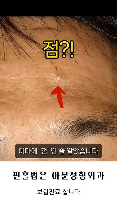 오래된 점 뾰루지 피지 압출 핀홀법 피지낭종 표피낭종 지방종 수술 성형외과 병원 Epidermal Cyst Nevus