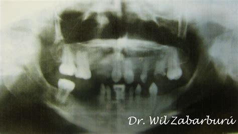 CLINICA DENTAL ASISTENCIAL DISPLASIA ECTODÉRMICA HIPOHIDRÓTICA