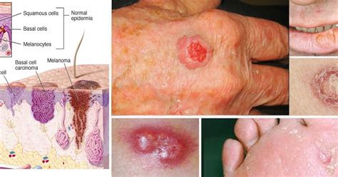 Stages Of Basal Cell Carcinoma Skin Cancer Types Of Most Common Cancer Early Skin Cancer