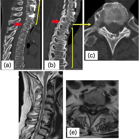 Preoperative Computed Tomography Ct T2 Weighted Magnetic Resonance