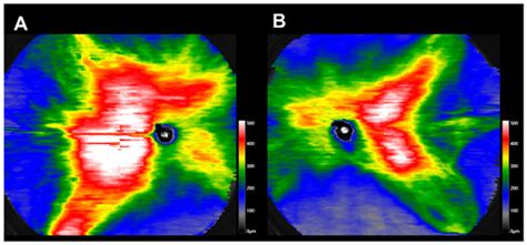 Sex And Age Dependent Wide Field Choroidal Thickness Differences In