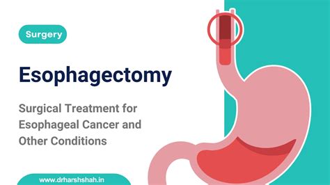 Esophagectomy A Complete Guide To Food Pipe Removal Surgery In India