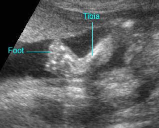 Rocker Bottom Feet Trisomy 18