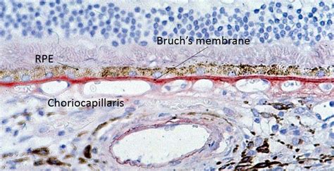 Light Microscopy Of Sorsbys Fundus Dystrophy A Showing Extensive
