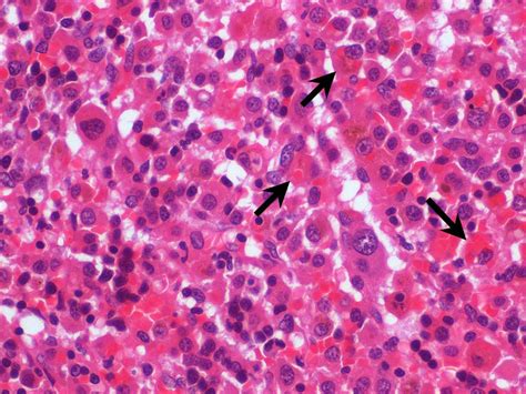 Haemophagocytic Histiocytic Sarcoma Case Study Cytopath
