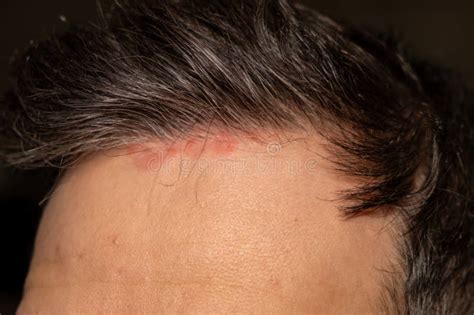 Skin Condition Showing Psoriasis Patches On The Forehead With Visible