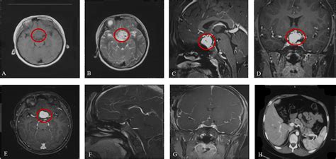 A Patient With A Large Brain Tumor Is Admitted Mapasgmaes
