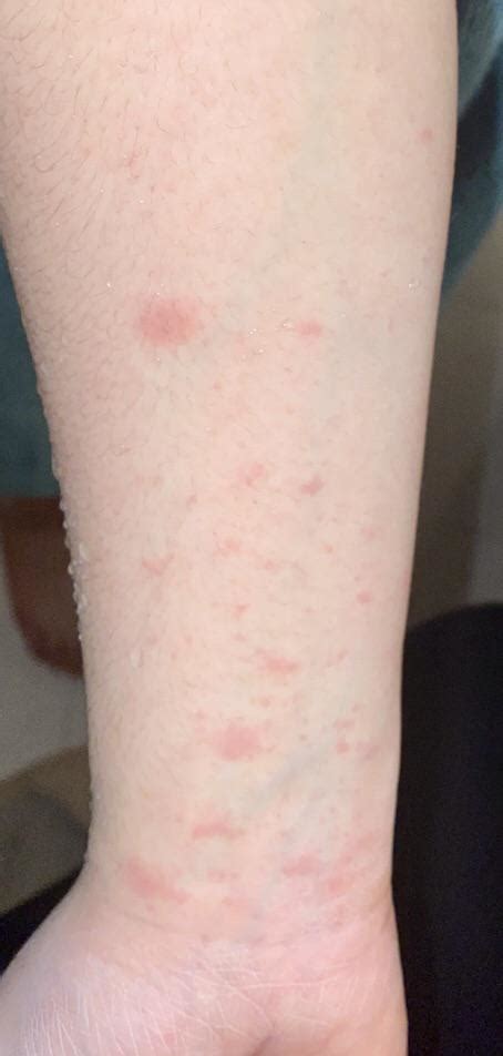Red Bumps On My Arm Rskincareaddiction