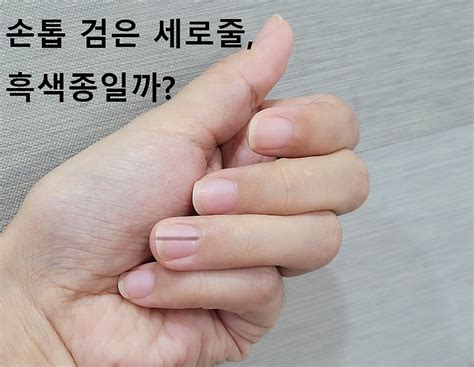손톱 검은 세로줄 혹시 흑색종일까 건강한 하블리네♡